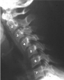 Cervical Facet Dislocations & Fractures - Spine - Orthobullets